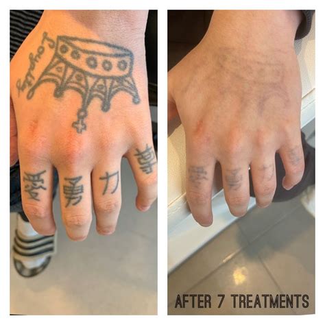 Tattooremoval Inyaclinic Inkremoval Tattoo Inya Cosmetic Skin Clinic