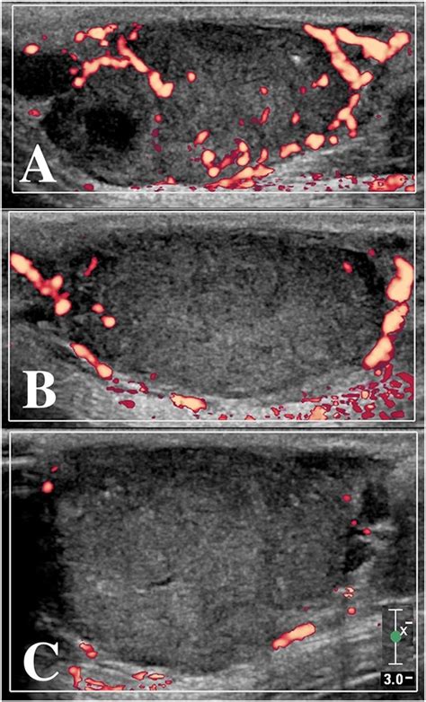 Tumour Vascularization As Measured By Power Doppler Ultrasound Of A