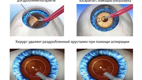 Лечение катаракты Операция и удаление катаракты Факоэмульсификация с имплантацией ИОЛ Youtube
