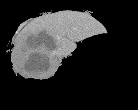 Image Processing Fuzzy C Means For Tumor Segmentation Using Matlab