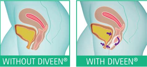 Urinary Incontinence B Braun