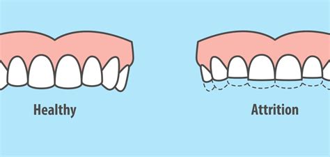 What Is Tooth Wear And How To Manage It Happiest Health