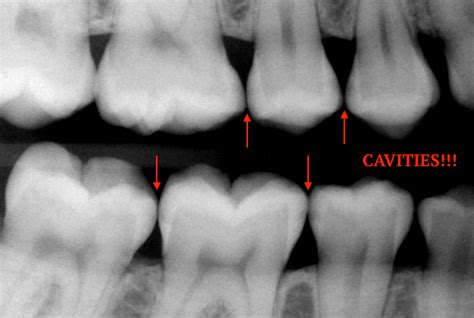 What Does A Dark Spot On A Dental X Ray Mean At Taj Schauer Blog