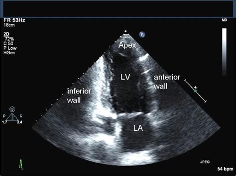 Transthoracic Echo Echo Hospital Pictures Echocardiogram