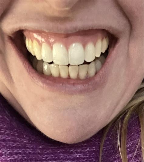 Finished R Invisalign