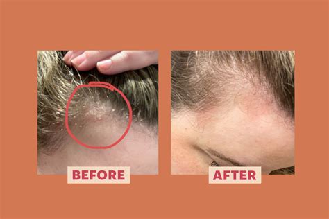 Mild Plaque Psoriasis On Scalp