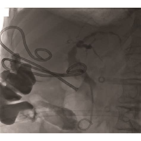 Cholangiogram At ERCP Showing An Mm Common Bile Duct Stone With Download Scientific Diagram