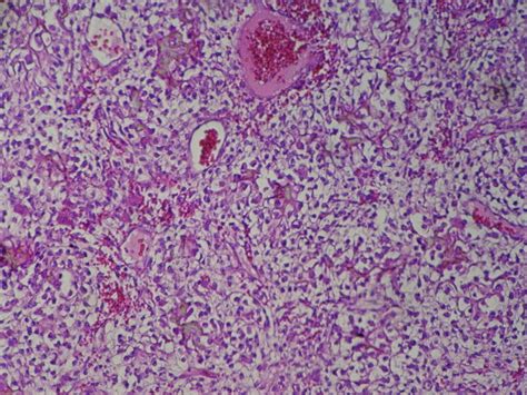 Sheet Like Arrangement Of Tumor Cells In Clear Cell Chondrosarcoma