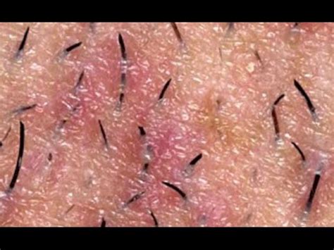 Ingrown Hairs From Shaving Medical Term For Ingrown Hairs Hd Youtube