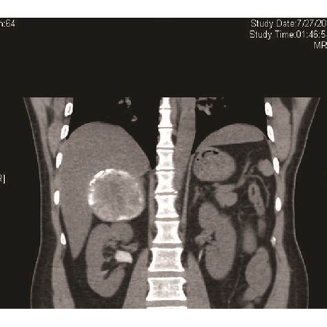 What Is Adrenal Gland Calcification At Justin Goodenough Blog
