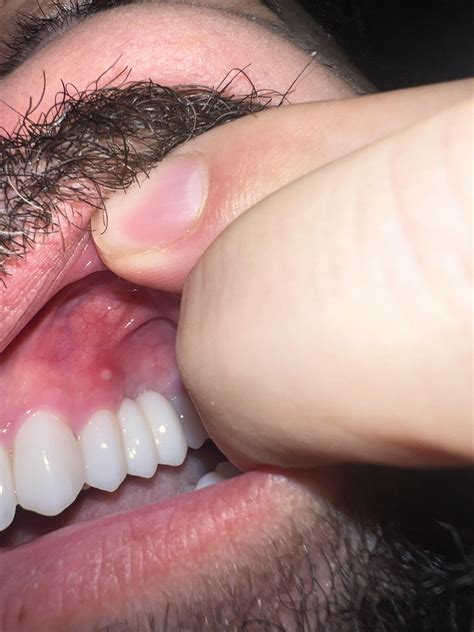 Pimple Above New Dental Bridge R Askdentists