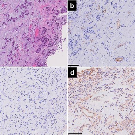 Photomicrographs Of The Thoracoscopic Pleural Biopsy Specimen Taken Download Scientific Diagram