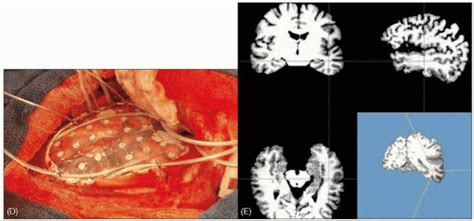 Insular Lobe Epilepsy Neupsy Key