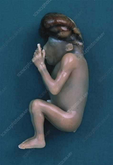 Anencephalic Aborted Foetus Stock Image M3500055 Science Photo