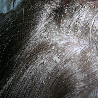 How To Get Rid Of Dry Scalp Flakes