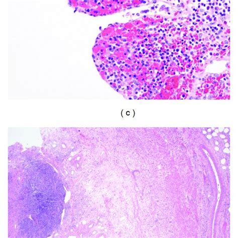 A Cross Section Of Appendix With Disrupted Mucosal Surface And Small Download Scientific