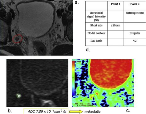 An Example Of Metastatic Lymph Node A T2w Image B Dw Image C Download Scientific