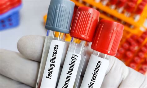 Impaired Fasting Glycemia IFG Impaired Fasting Glucose
