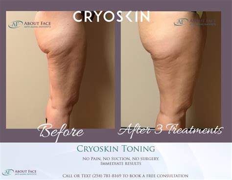 Cryo Slimming Thighs Before And After At Paul Caison Blog
