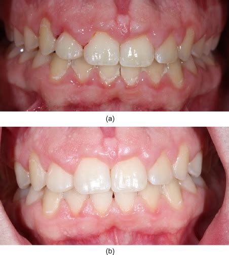 Periodontal Considerations In Orthodontic Treatment A Review Of The