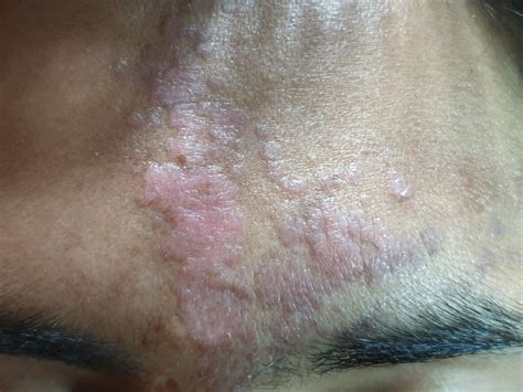 Global Skin Atlas Diagnosis Detail