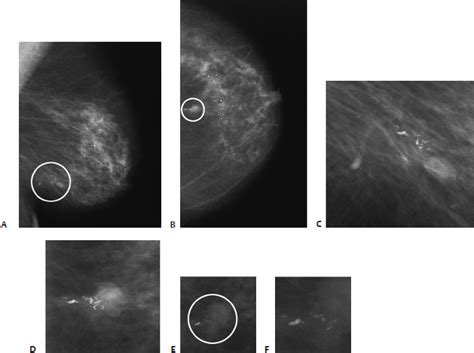 Calcifications Fine Linear Branching Microcalcifications Radiology Key