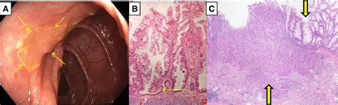 Figure 1 From Sessile Serrated Polyps And Colon Cancer Prevention