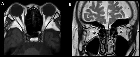 Kearns Sayre Syndrome With Restricted Diffusion In Subcortical White