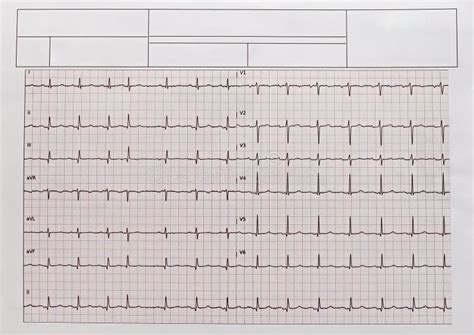 Detailed Ekg Ecg Electrocardiogram Showing Heartbeat Patterns Stock Image Image Of Print