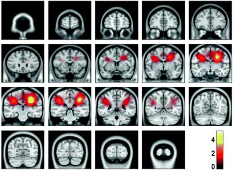 To Estimate Functional And Effective Brain Connectivity From Meg Data Robust To Artifacts Of