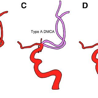 Illustration Of A Normal MCA And Double MCA Trunks A Normal MCA B Download Scientific