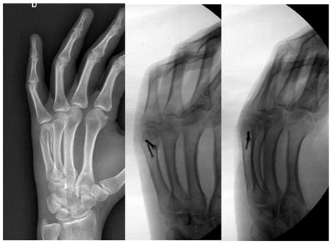 Fratura Do Metacarpo Quais São Suas Causas E Tratamentos