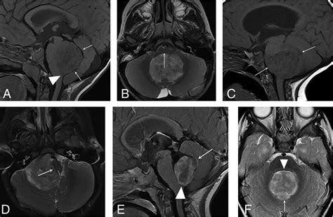 Anatomic Neuroimaging Characteristics Of Posterior Fossa Type A