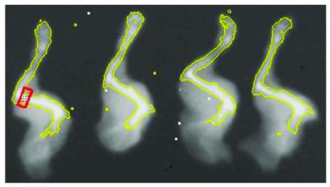 Example Of Humerus Bone Distal Region Dual Energy X Ray Absorptiometry