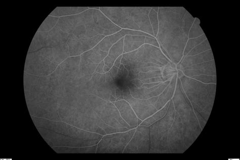 Vessel Enhancement Dengan Hessian Matrix Dari Gauge Coordinate Dr Ahmad Nasikun