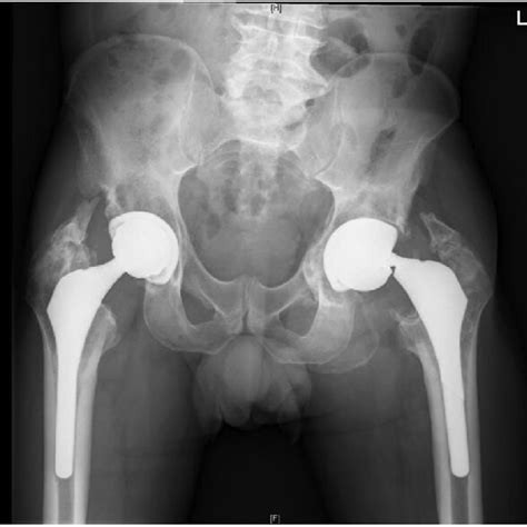 Axial T2 Mars Mri Pelvis With Contrast Demonstrates Pseudotumor Download Scientific Diagram