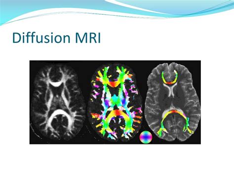 Ppt Magnetic Resonance Imaging Mri Powerpoint Presentation Free Download Id 1473814