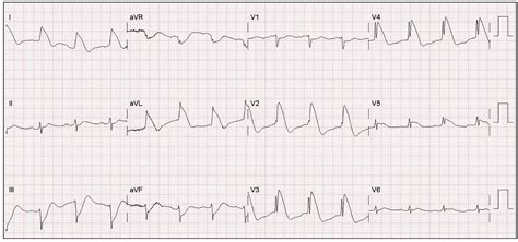 Its Greek To Me Electrocardiographic Lambda Sign The American