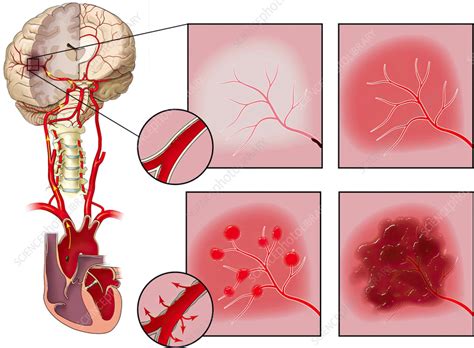 Progression Of Embolic Stroke Illustration Stock Image C059 3360 Science Photo Library