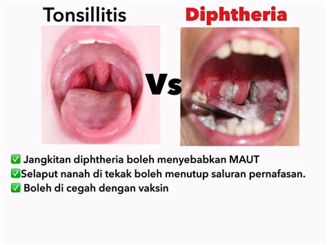 Apa Beza Sakit Tonsil Yang Biasa Dengan Difteria Doc Klinik Sabah