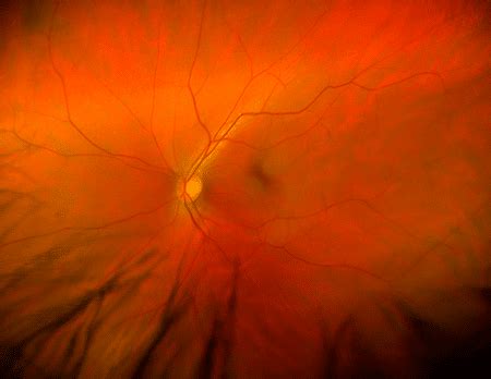Cataracts OOMC