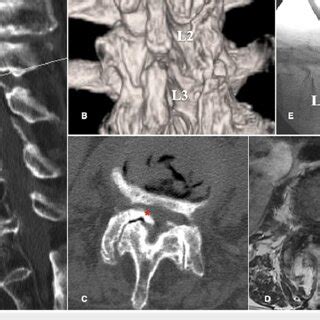Preoperative Imaging A Sagittal CT Confirmed An L3 Compression Download Scientific Diagram