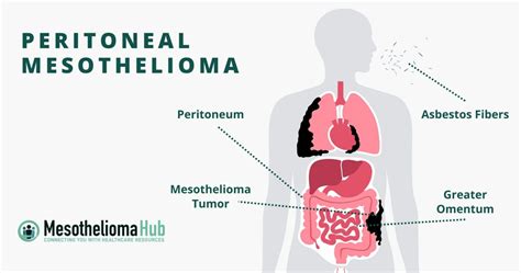 Peritoneal Mesothelioma Causes Symptoms And Treatment