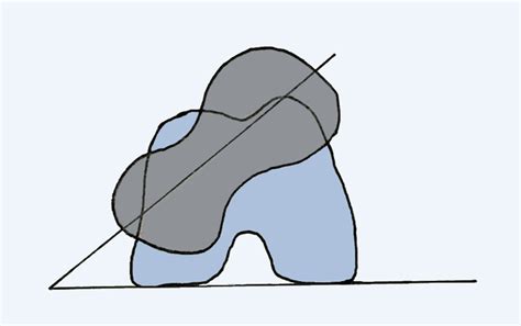 The Measurement Of Femoral Anteversion Download Scientific Diagram