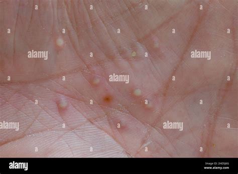 Macro Photography Of Pustular Psoriasis Lesions Palmoplantar Psoriasis