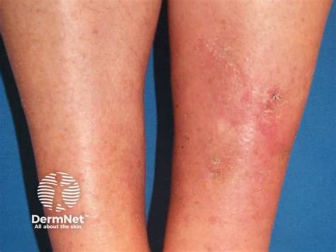 Rash On Legs Only