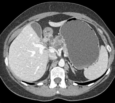 Serous Cystadenoma Pancreas Radiology Case Studies Ctisus Ct Scanning