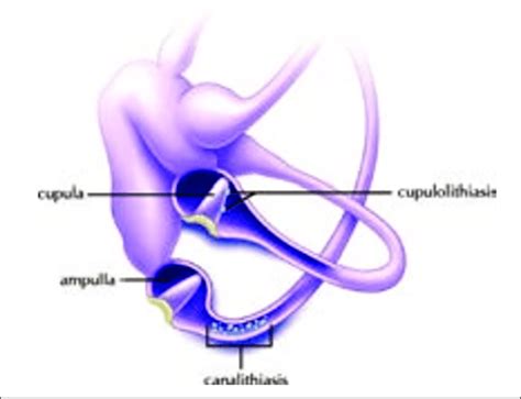 Llustration Of Canalithiasis Of The Posterior Canal And Cupulolithiasis