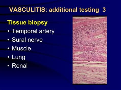 2015 Mangement Of Systemic Vasculitis Ppt
