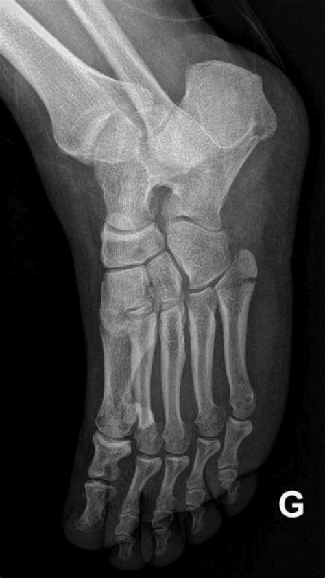 Case Report Pseudarthrosis Dsbiologicals